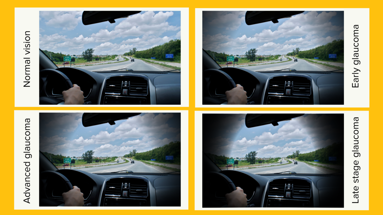 Glaucoma Treatment La Cañada - Perception Optometry